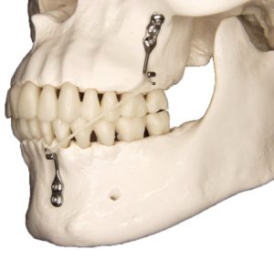 Druhy rovnátek – Ortodoncie MUDr. Petr Kolář